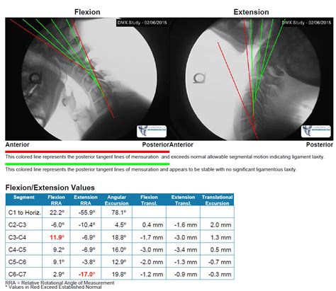 Documenting Cervical Instability On Flexion And Extension