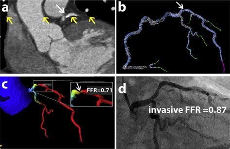 A Case Example Of Misalignment Artifacts A 54 Year Old Man Presenting