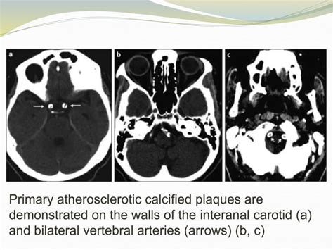 Physiological And Pathological Calcification Of Brain Pptx
