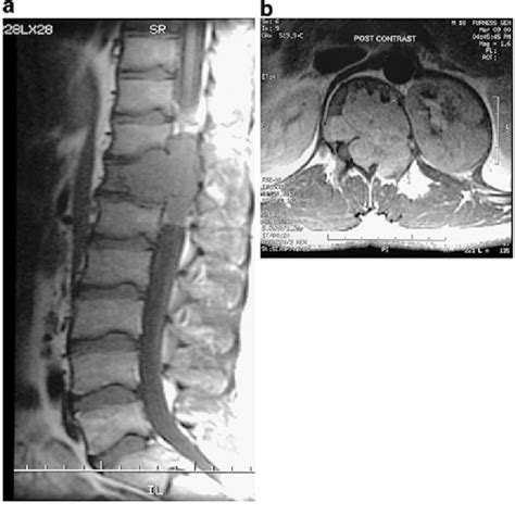 Thoracolumbar X Ray Showing A D12 Vertebral Body Abnormality With