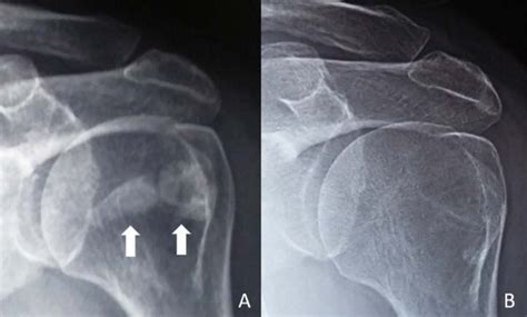 Treatment Protocol For Rotator Cuff Calcific Tendinitis Using A Single Crystal Piezoelectric