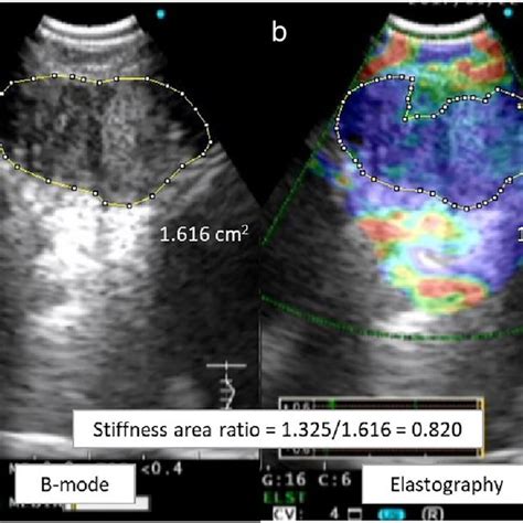 Endobronchial Ultrasound Convex Probe Download Scientific Diagram