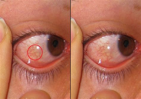 Chemosis