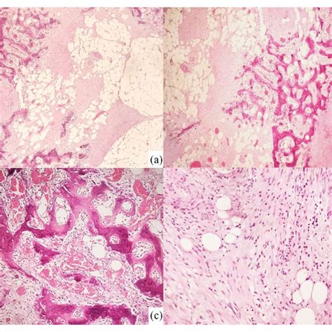 Calcification In The Mesenteric Root At Ct Scan Download Scientific
