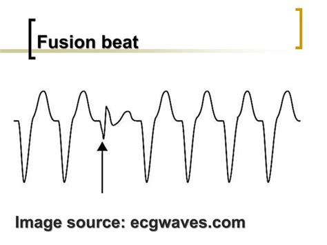 Broad Complex Tachycardia Ppt