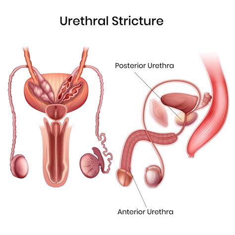 Urethral Stricture Metromale Clinic And Fertility Center