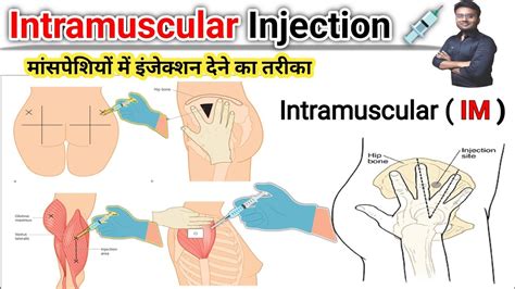 Intramuscular Injection Technique On Deltoid How To Give An