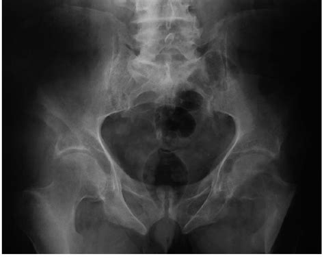 Radiograph Of The Pelvis Lytic Lesion Of The Left Femoral Neck