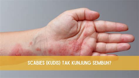 Kenapa Scabies Tidak Sembuh Sembuh
