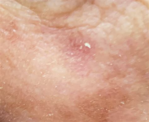 Actinic Keratosis