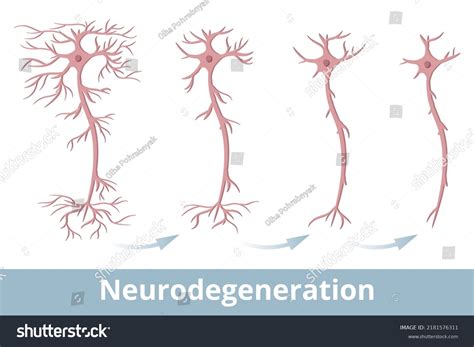 84 Neuron Degeneration Stock Vectors And Vector Art Shutterstock
