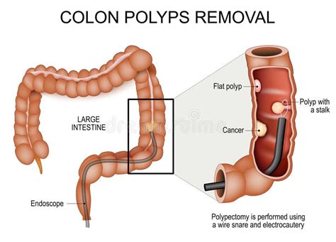 Colon Polyps Removal Colonoscopy And Polypectomy Stock Vector