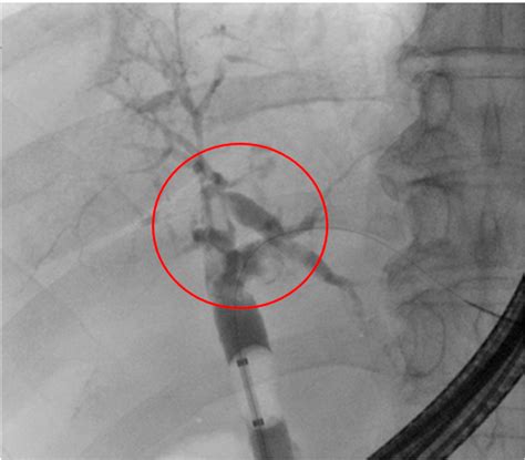 Figure 1 From Incidence Of Secondary Sclerosing Cholangitis In