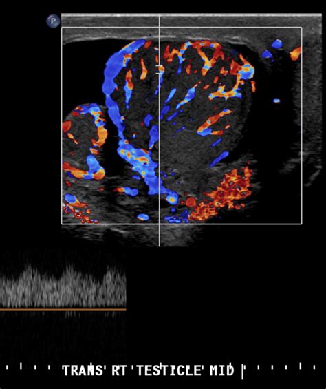 Epididymo Orchitis Radiology Case