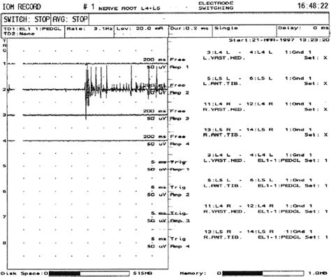 Electromyography Anesthesia Key
