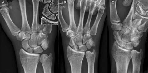 Fractura De Escafoides Síntomas Diagnóstico Y Tratamiento