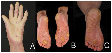 Foot Plantar Keratosis