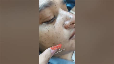 আচিল মোল তিল সহজেই রিমুভ করুন আই লিপ বিউটি সেলুন 01703252936 Youtube