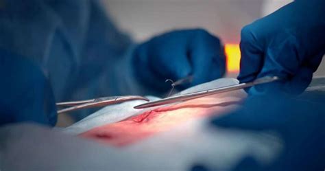 Private Cyst Removal Excellent Results Simon Payne