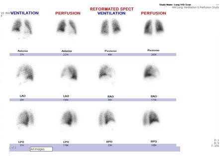 Lung Segments Vq