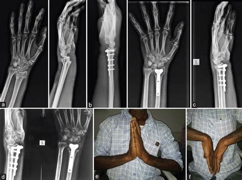 Volar Plating In Distal End Radius Fractures And Its Clinical And