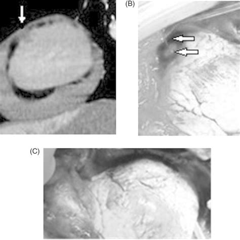 A A Preoperative Computed Tomography Ct Scan Shows Massive Download Scientific Diagram
