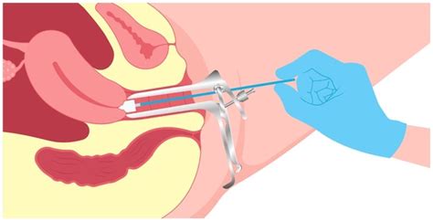 Adenocarcinoma Cervix Over 25 Royalty Free Licensable Stock