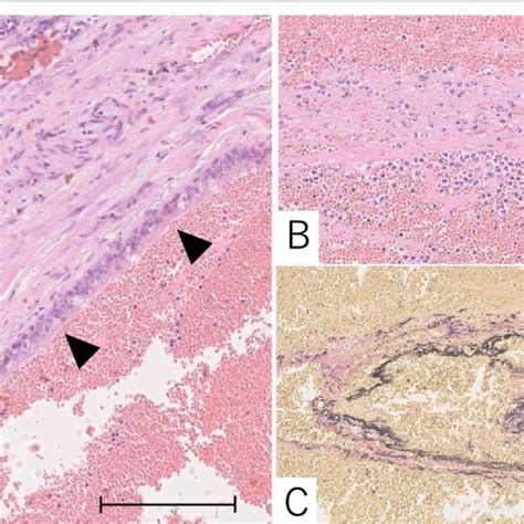 A Histopathological Findings Showing That The Primary Bleeding Site Was Download Scientific