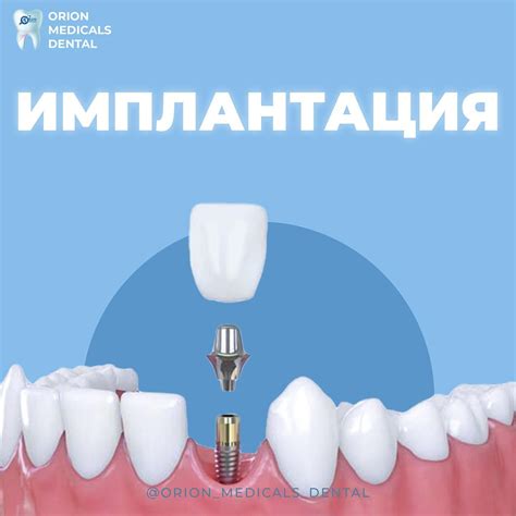 Orion Medicals Dental Почему многие люди долго настраиваются на установку импланта⁉️ Страх