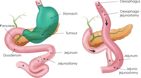 Total Gastrectomy