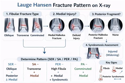 Lauge Hansen Ankle Fractures Se4 Mnemonic And Types Explained