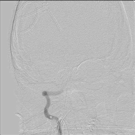 Radiopaedia Case Subarachnoid Hemorrhage Posterior Fossa Id 34421