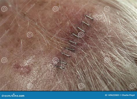 Post Surgery View Of Mohs Procedure Site Stock Image Image Of Carolina Carcinoma 149622083