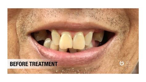 Removable Denture Bali Family Dental Care
