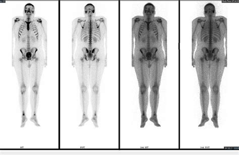 Tc 99m Mdp Bone Scintigraphy Showed Bilaterally Increased Uptake Within Download Scientific