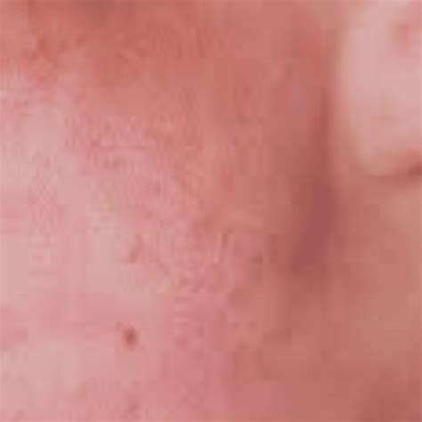 Hiv Blisters Arms