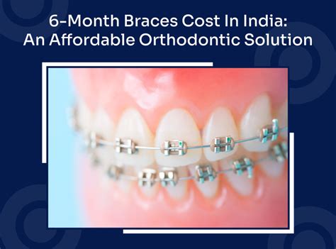 6 Month Braces Cost In India The Price Of A Perfect Smile