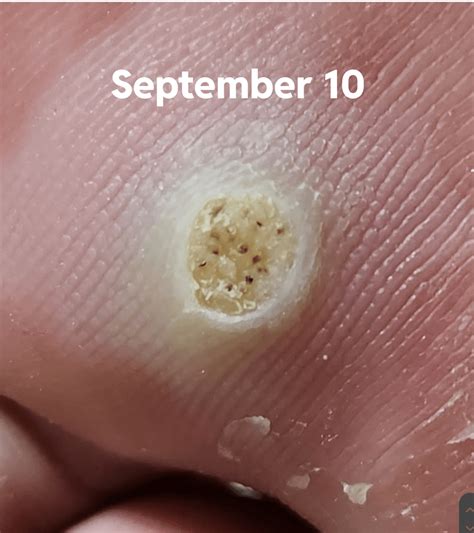 Duct Tape Method One Week Difference Rwarts