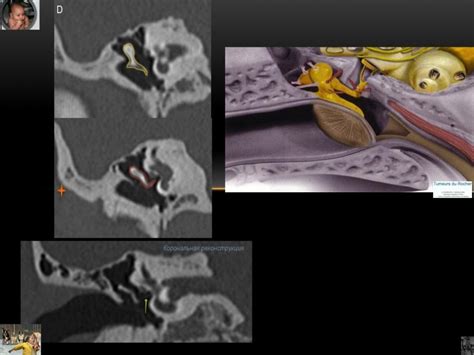 Компьютерная томография височной кости