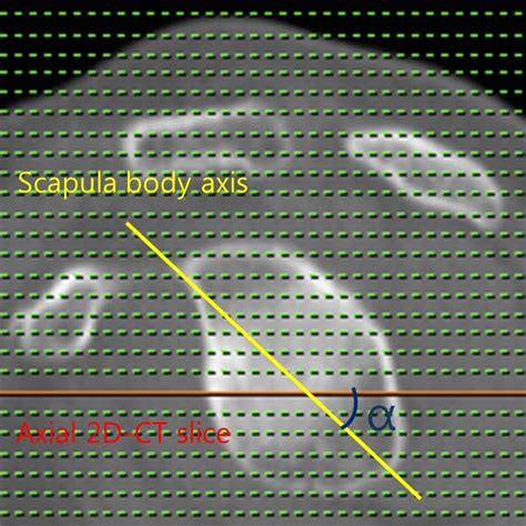 The Glenoid Version As Measured On An Axial Two Dimensional Computed