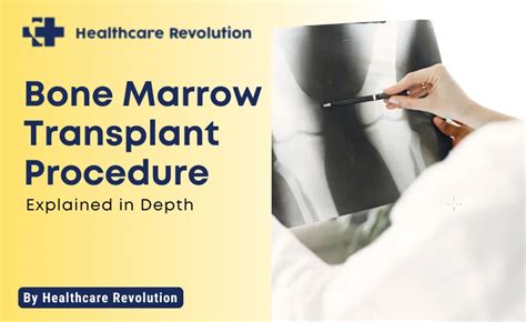 Bone Marrow Transplant Procedure Explained Step By Step