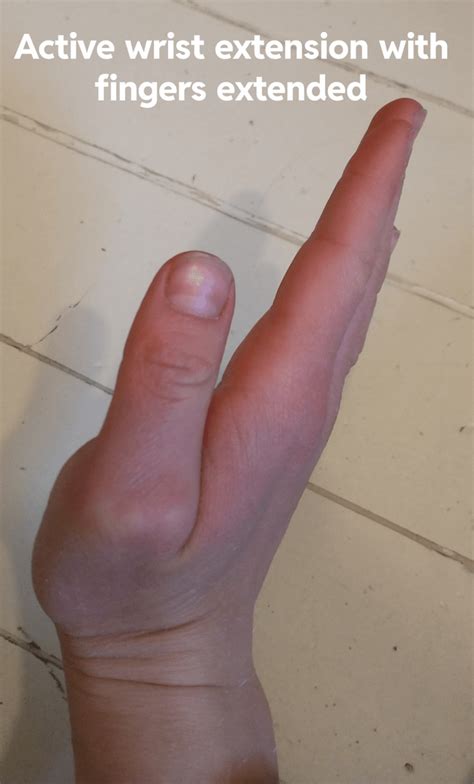 Is This A Sign Of Weak Finger Extensors Could This Be Why I Get Wrist Pain During Handstands Is This A Sign Of Weak Finger Extensors Could This Be Why I Get Wrist Pain During Handstands