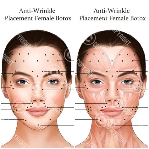 Botox Injection Points Bundle Botox And Filler Injector Anatomy Poster Art Aesthetics Dermatology