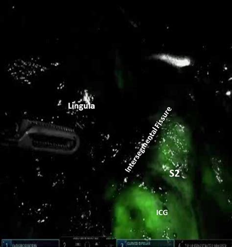 The Technique Of Robotic Anatomic Pulmonary Segmentectomy Ii Left