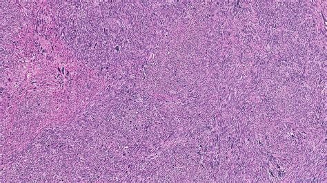 Leiomyoma Atlas Of Pathology