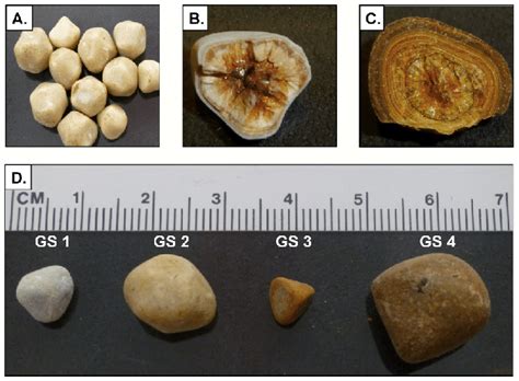 Gallstones In Gallbladder