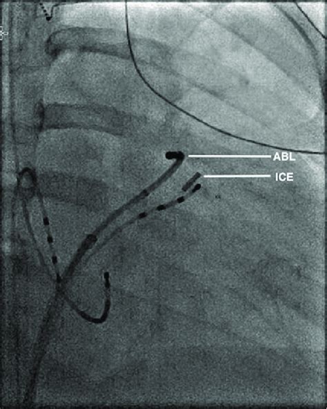 Biplane Fluoroscopy Image Right Anterior Oblique 30 Degrees Of The Download Scientific