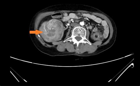 Computed Tomography Revealed Ascending Colonic Intussusception Download Scientific Diagram