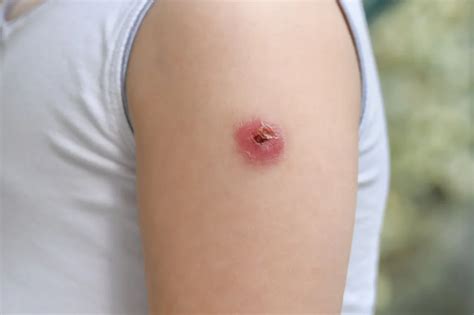 Infected Insect Bites Blackpool Express Chemist