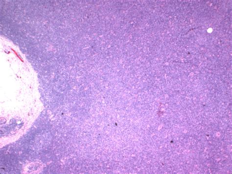 Lymph Node Involved With Chronic Lymphocytic Leukemia Showing Download Scientific Diagram